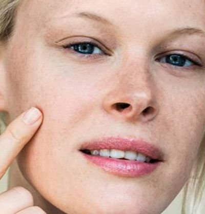 Akne Narben erfolgreich heilen und entfernen - Garnier